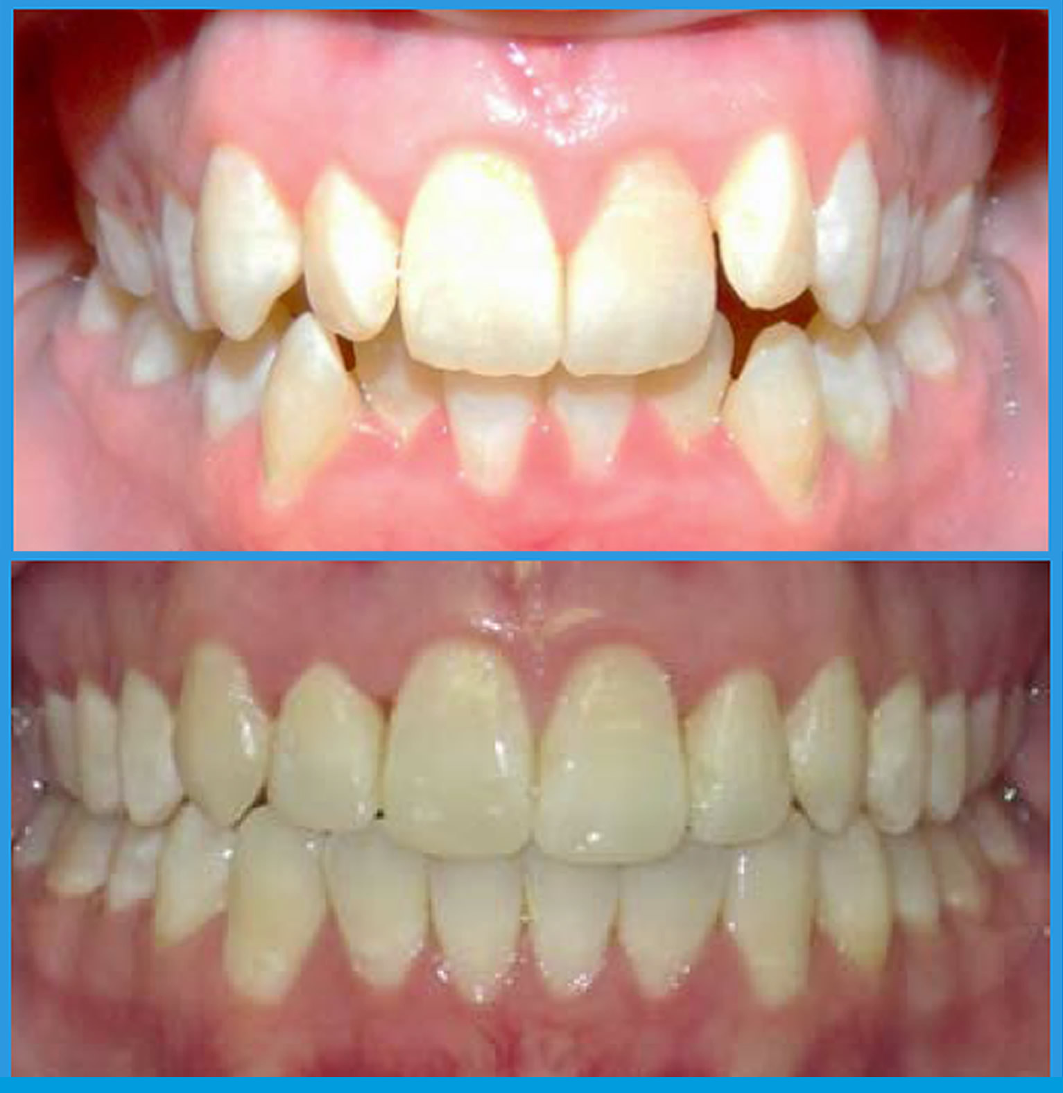 braces-before-after - Dental Associates of Connecticut