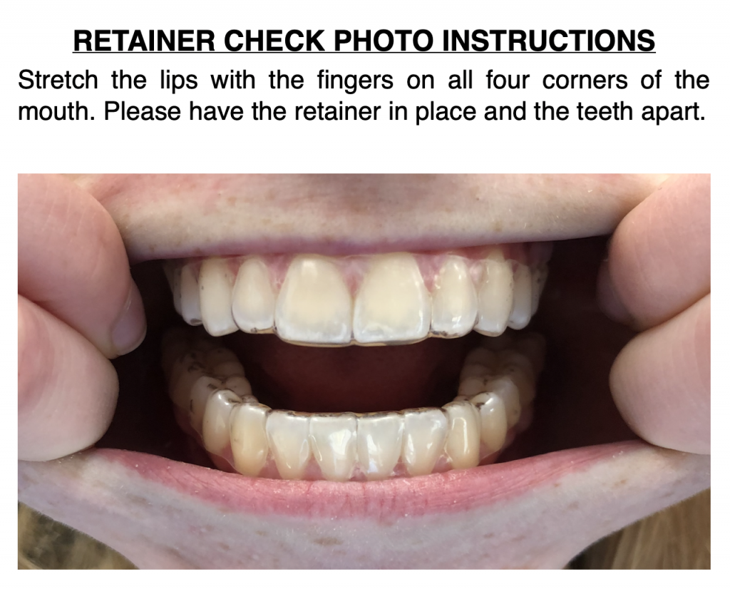 Retainer Check Photo - Dental Associates of Connecticut